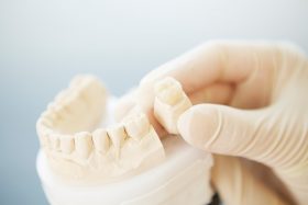 Operative Zahnentfernung - Dr. Pawlenka